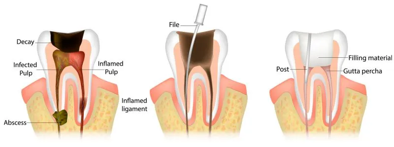 What to Expect During a Root Canal Procedure