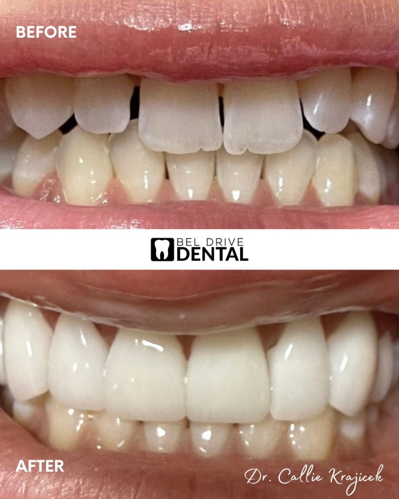 Smile Makeovers Made Simple with Porcelain Veneers